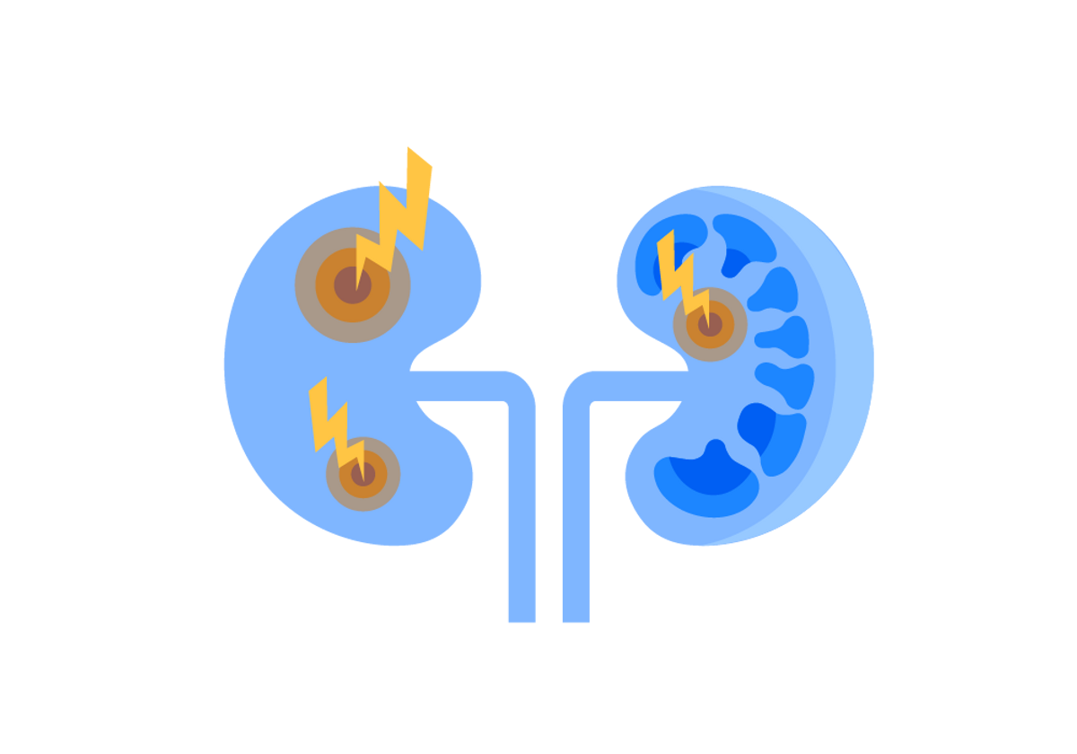 Interstitial Nephritis | 3 Causes, Symptoms & Diagnosis | Buoy