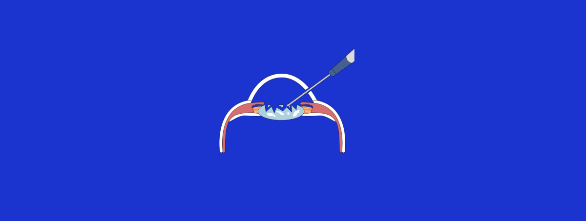 Understanding Eye Surgery: Types, Benefits, and Risks | Buoy