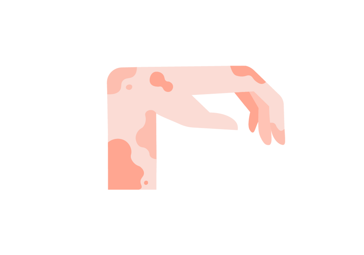 Giftefeu Behandlung Rezeptfrei