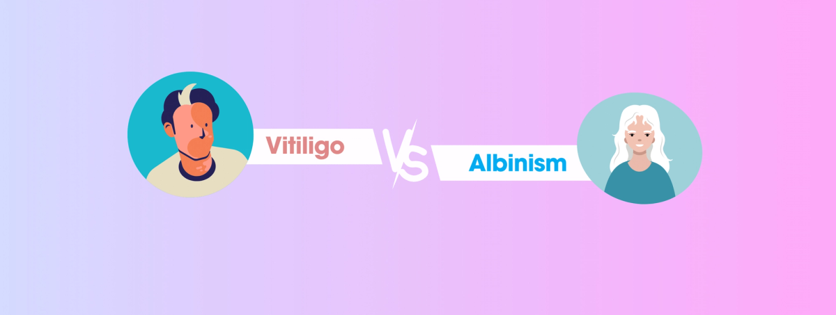 Vitiligo vs. Albinism: Key Differences