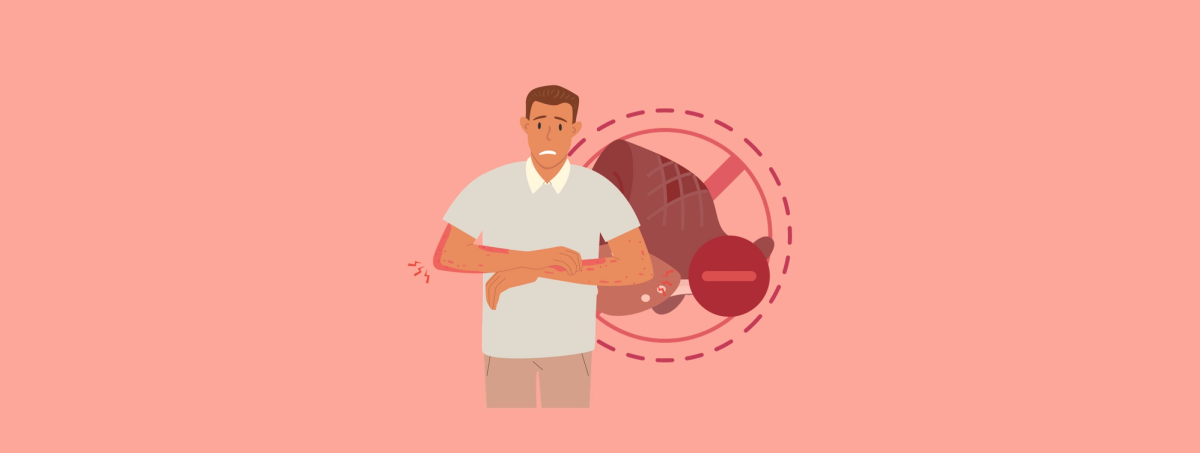 Red Meat Allergy: Symptoms, Diagnosis and Management | Buoy