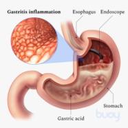 Gastritis What It Is Symptoms Causes Treatment 51 OFF