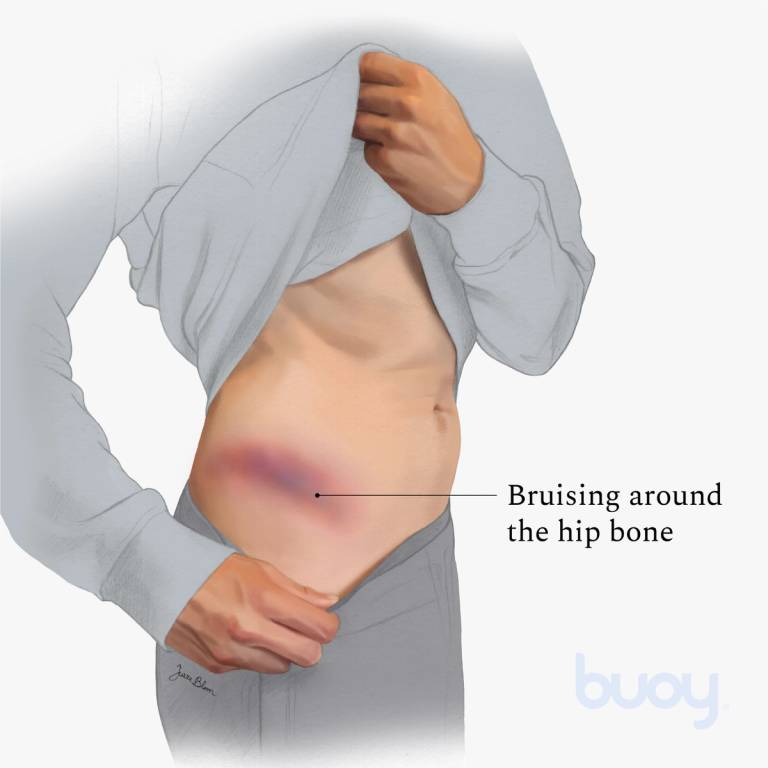 Left Flank Hematoma Left Flank Hematoma