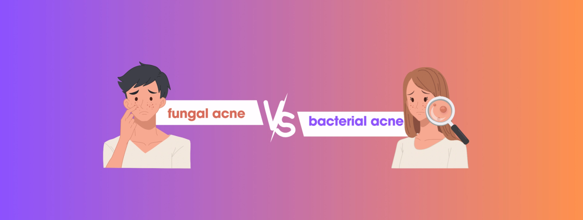 Fungal vs Bacterial Acne | Buoy