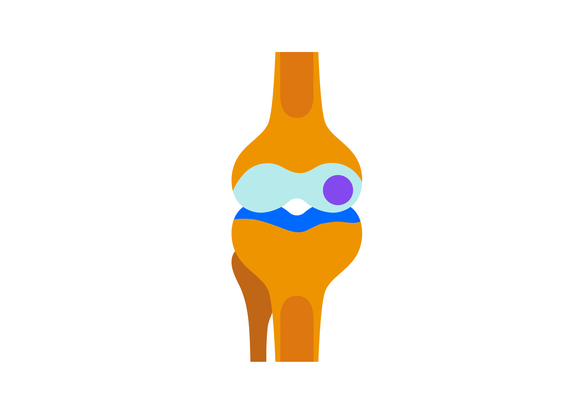 Osteocondritis Disecante | Causas, tratamiento y recuperación