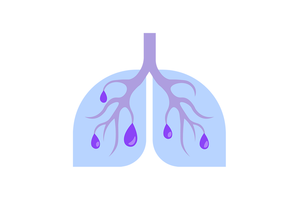 Bronchogenic Cyst | Causes, Locations in Body & Surgery