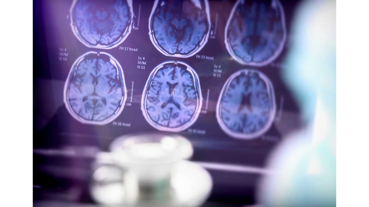 Unlocking the Bio-Hermes Study: A Leap Forward in Alzheimer's Disease ...