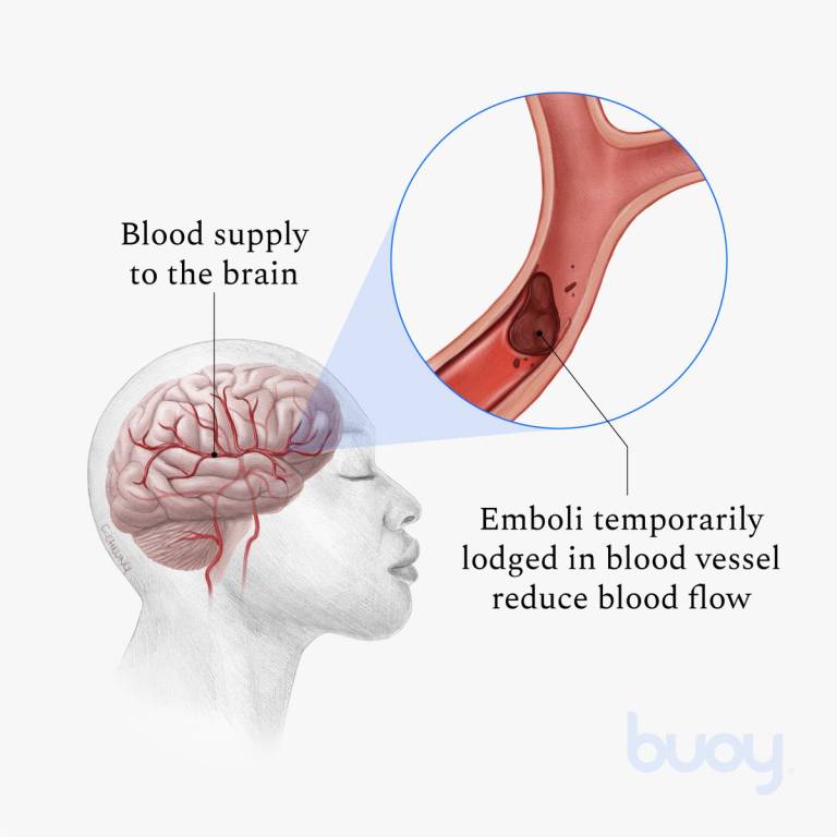 What Is A TIA Transient Ischemic Attack And How Can It 50 OFF What Is A TIA Transient Ischemic Attack And How Can It 50 OFF