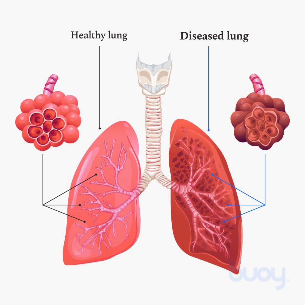 Emphysema Lung Vs Normal Lung