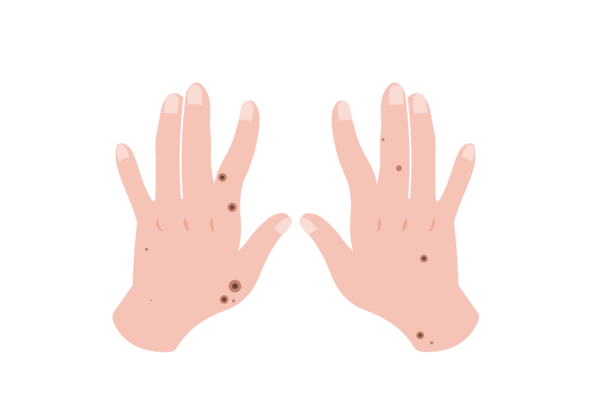 Disseminated Gonococcal Infection | STI Spread & Treatment | Buoy