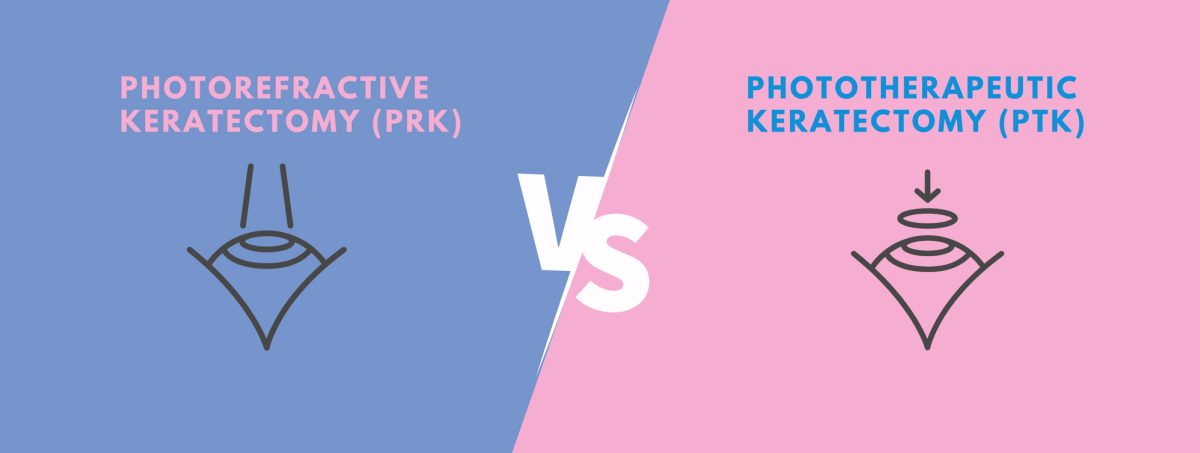 PRK vs PTK: Comparing Laser Eye Surgeries | Buoy