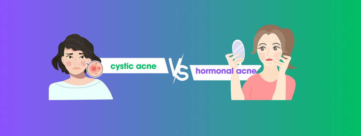 Cystic Acne vs Hormonal Acne | Buoy