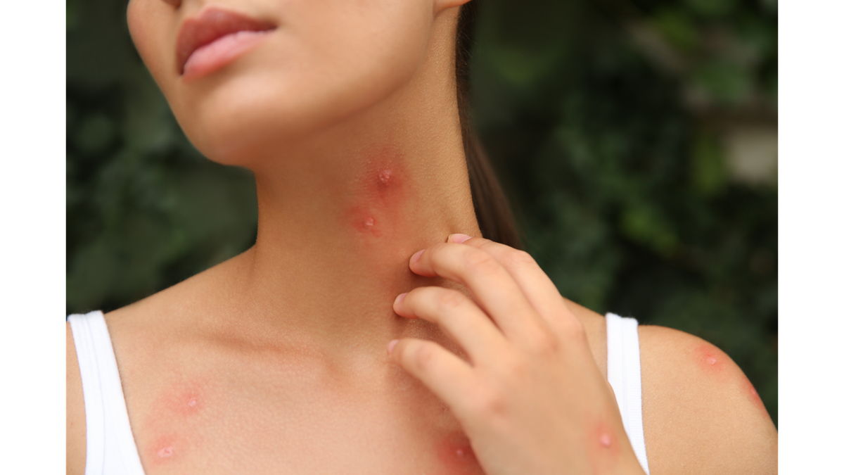 Scratch That Itch Away: Breakthrough Study Reveals Bacterial Culprit ...