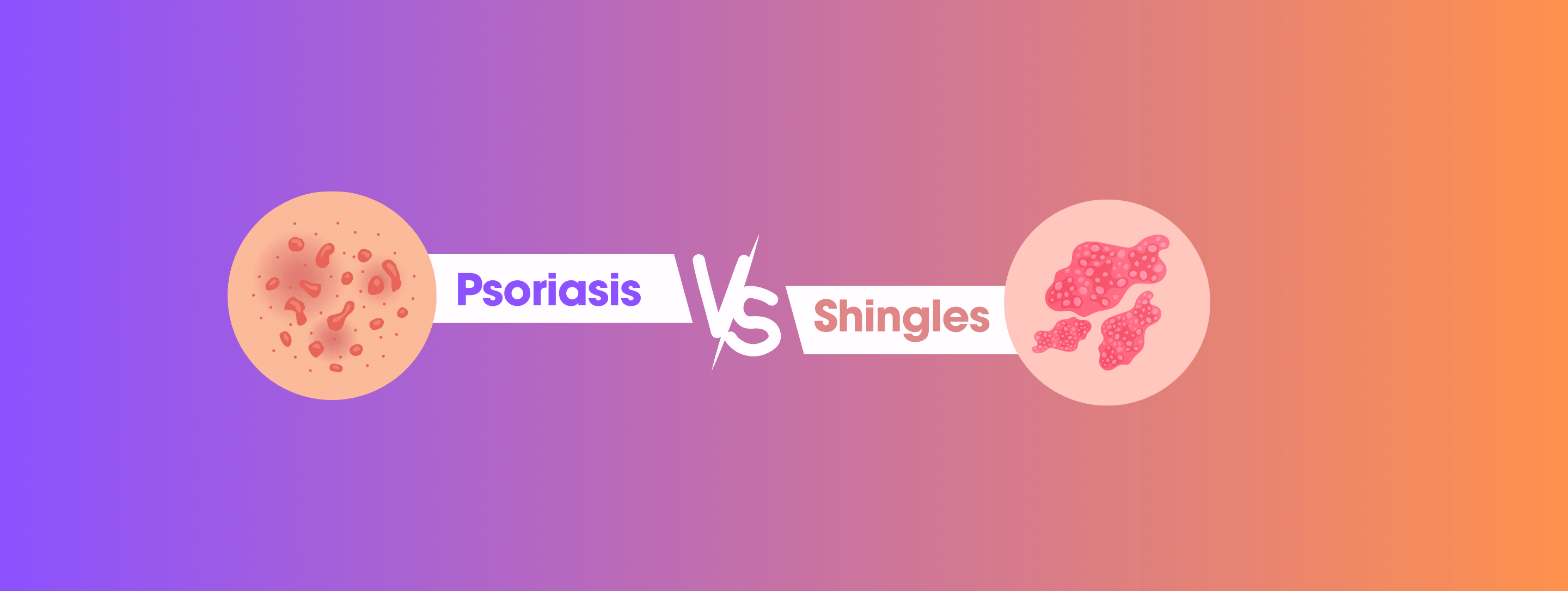 Shingles vs. Psoriasis: Distinguishing These Skin Conditions