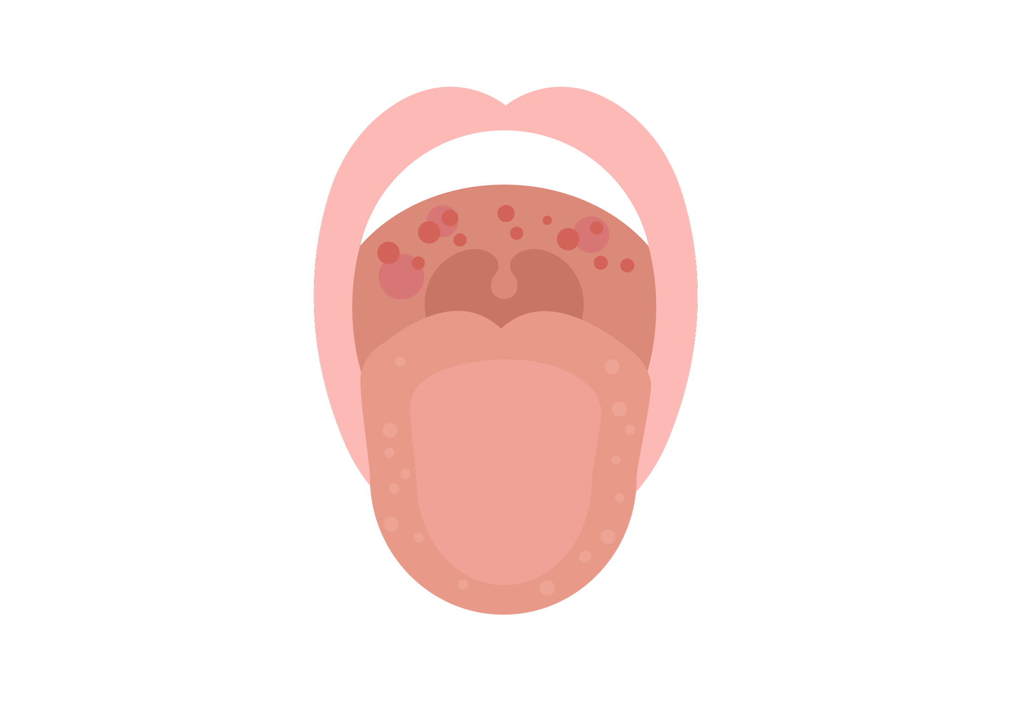 Red Spots in the Mouth | How to Treat Red Spots on Roof of Mouth