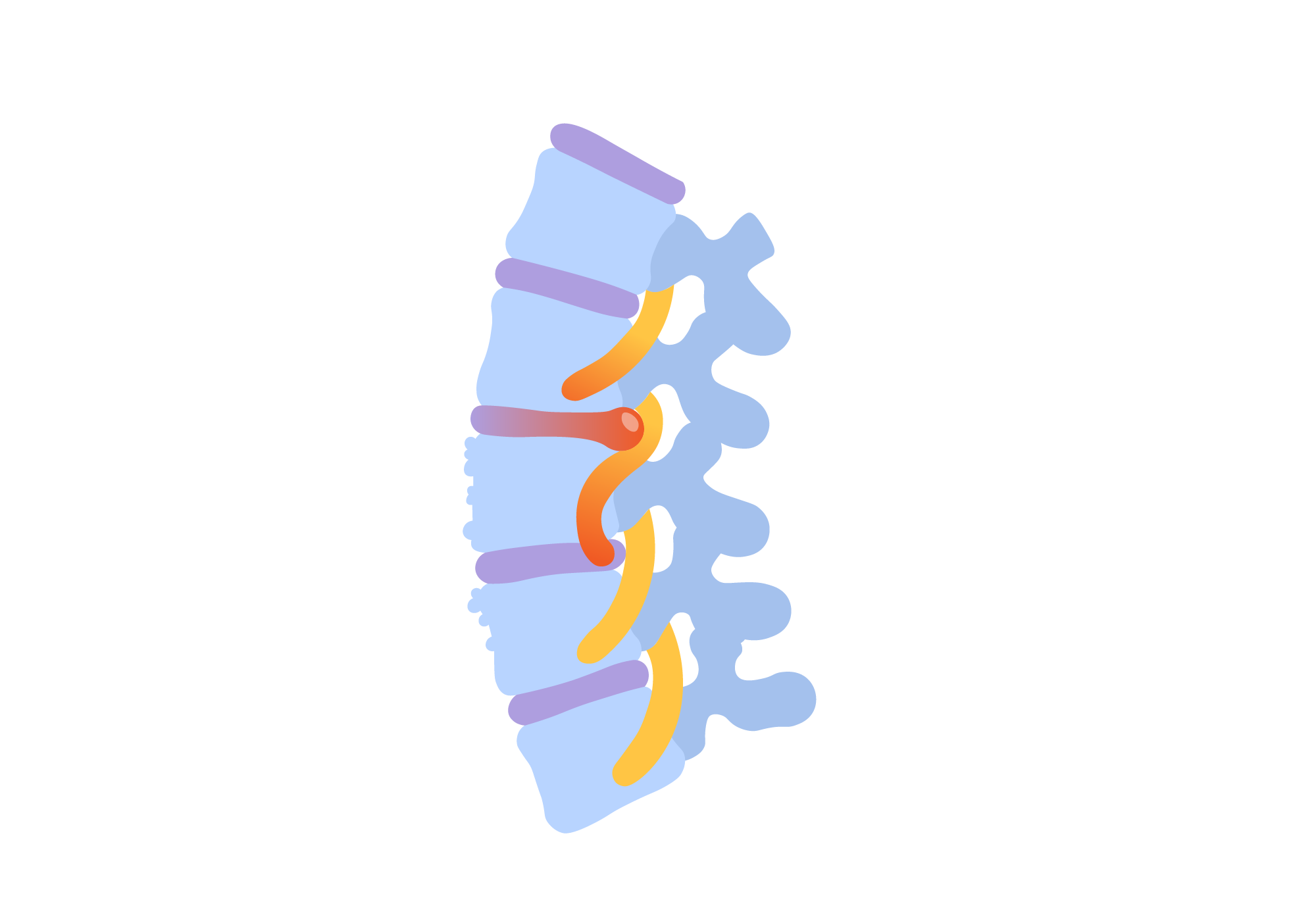 Estenosis espinal | Razones por las que ocurre la estenosis espinal y ...