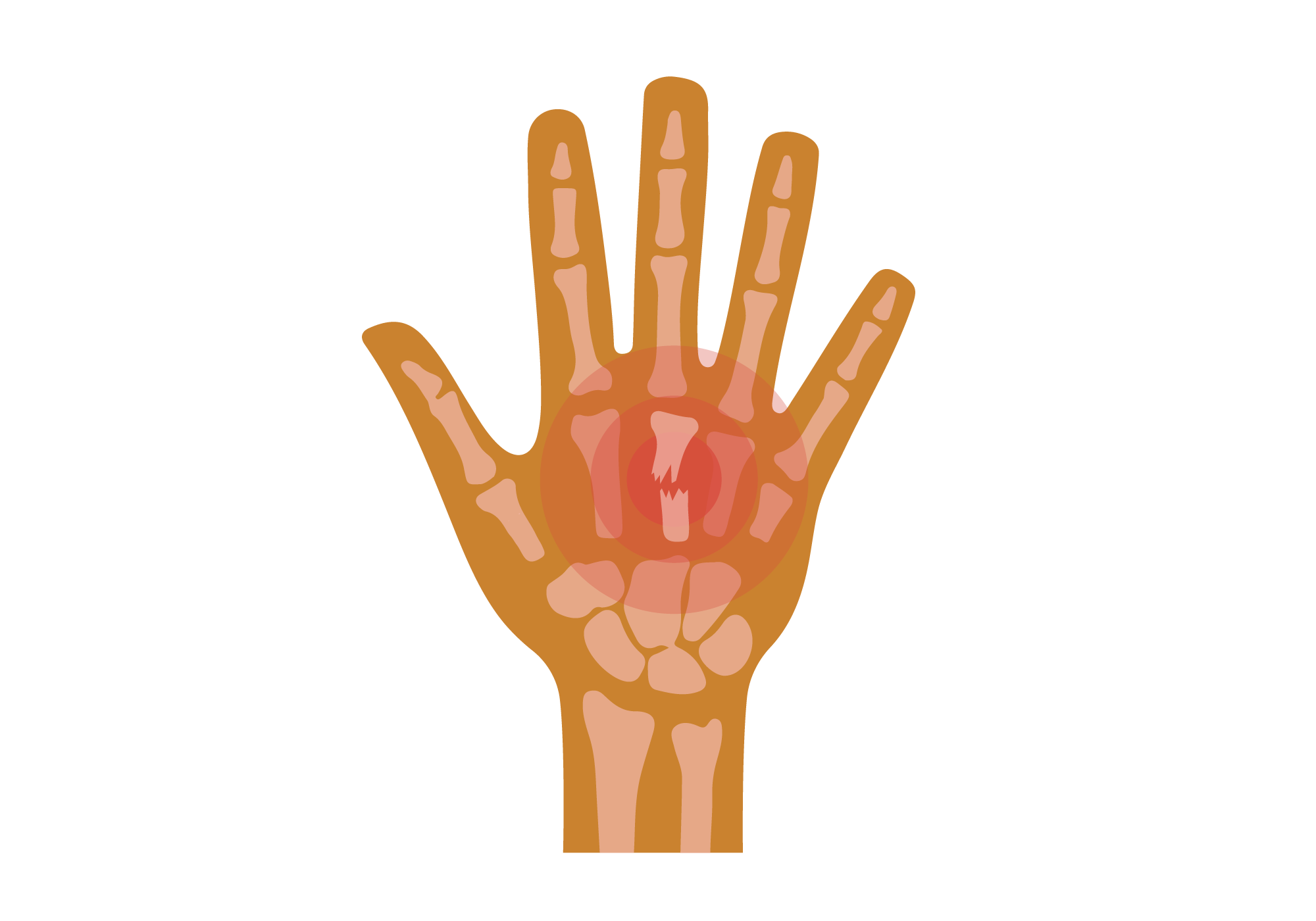 Broken Hand | Signs Your Hand Is Broken & How to Treat | Buoy