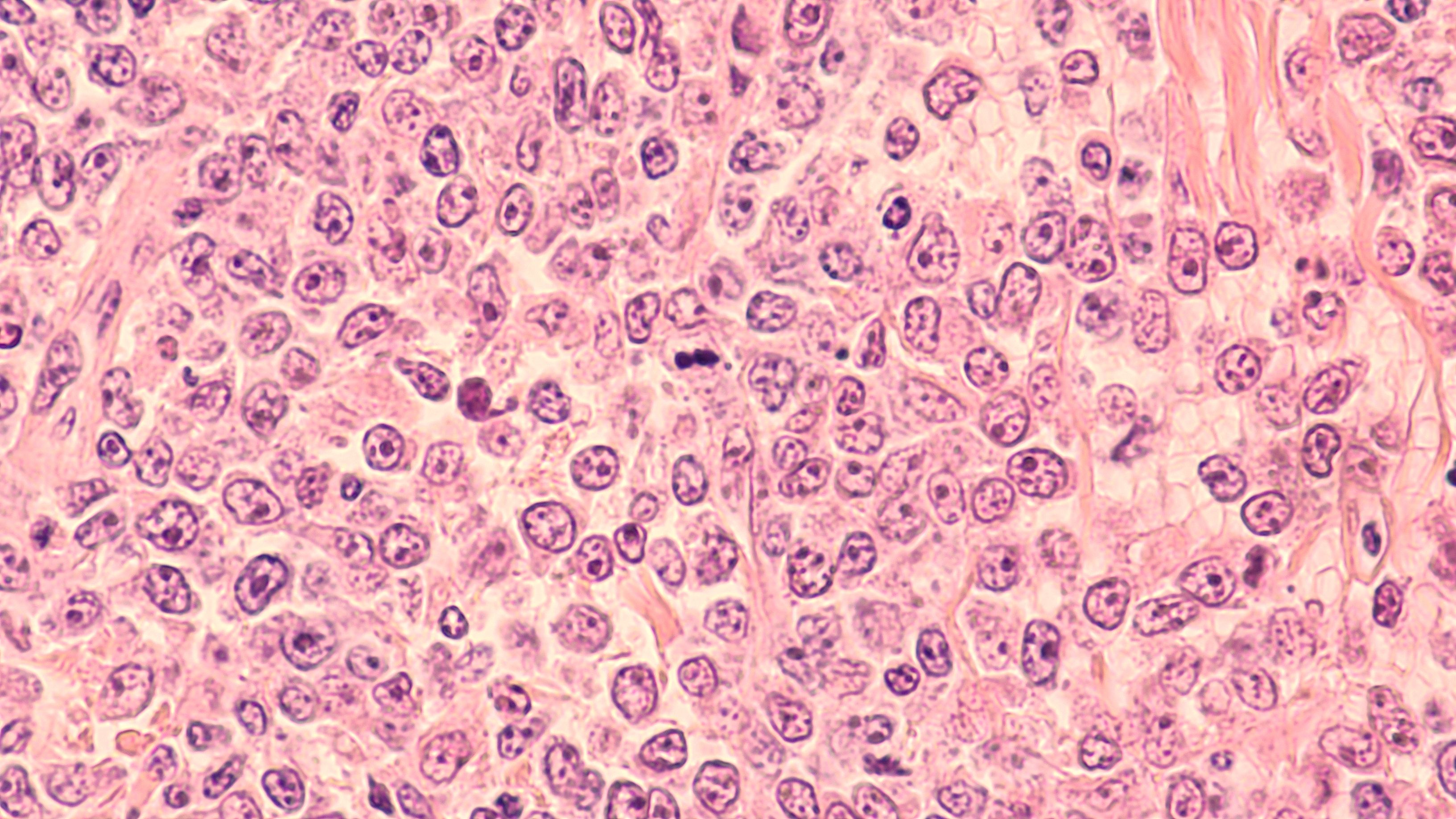 Columvi Combination for Diffuse Large B-Cell Lymphoma Achieves Primary ...