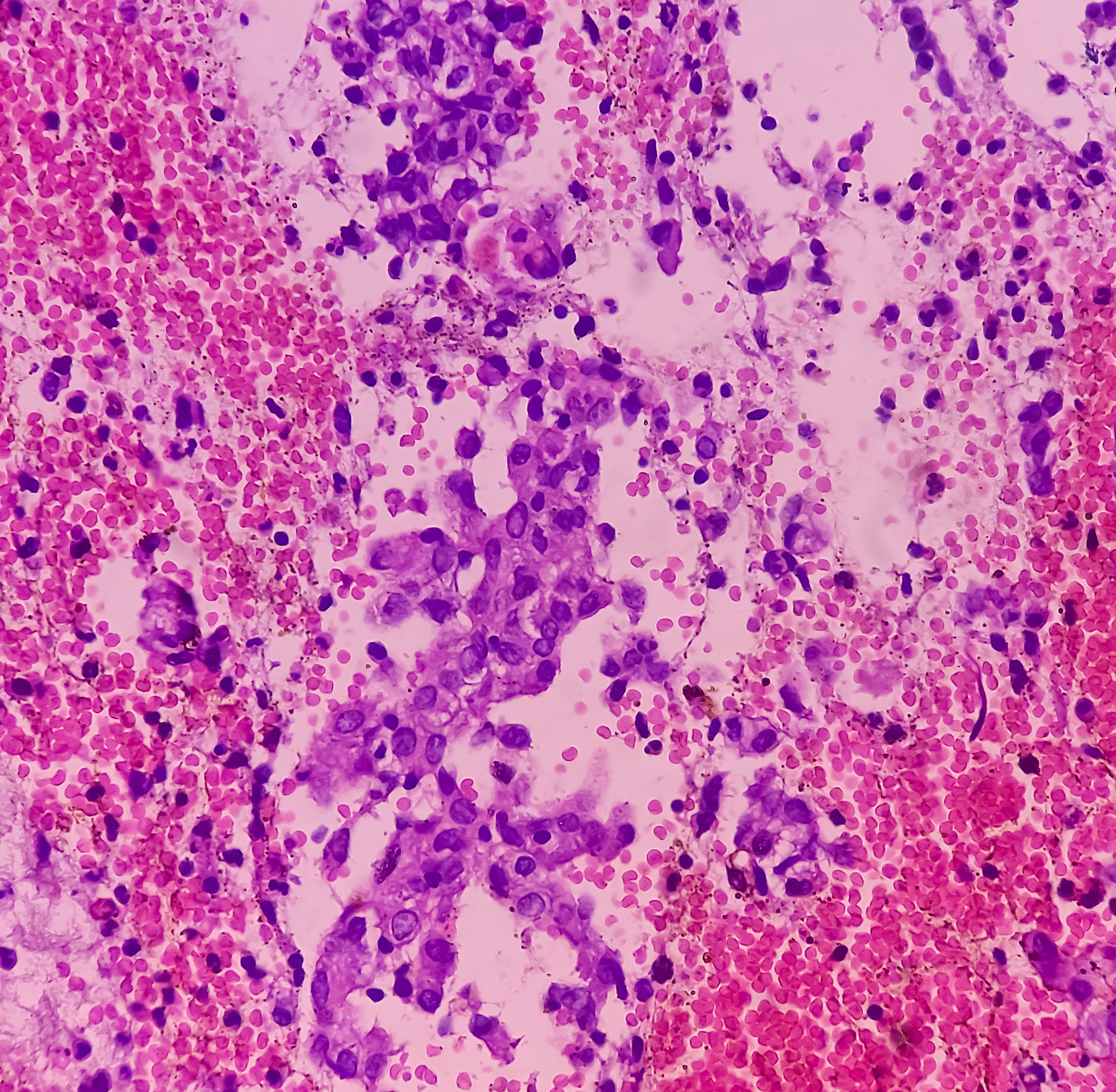Keytruda Combination Falls Short of Disease-Free Survival Primary ...