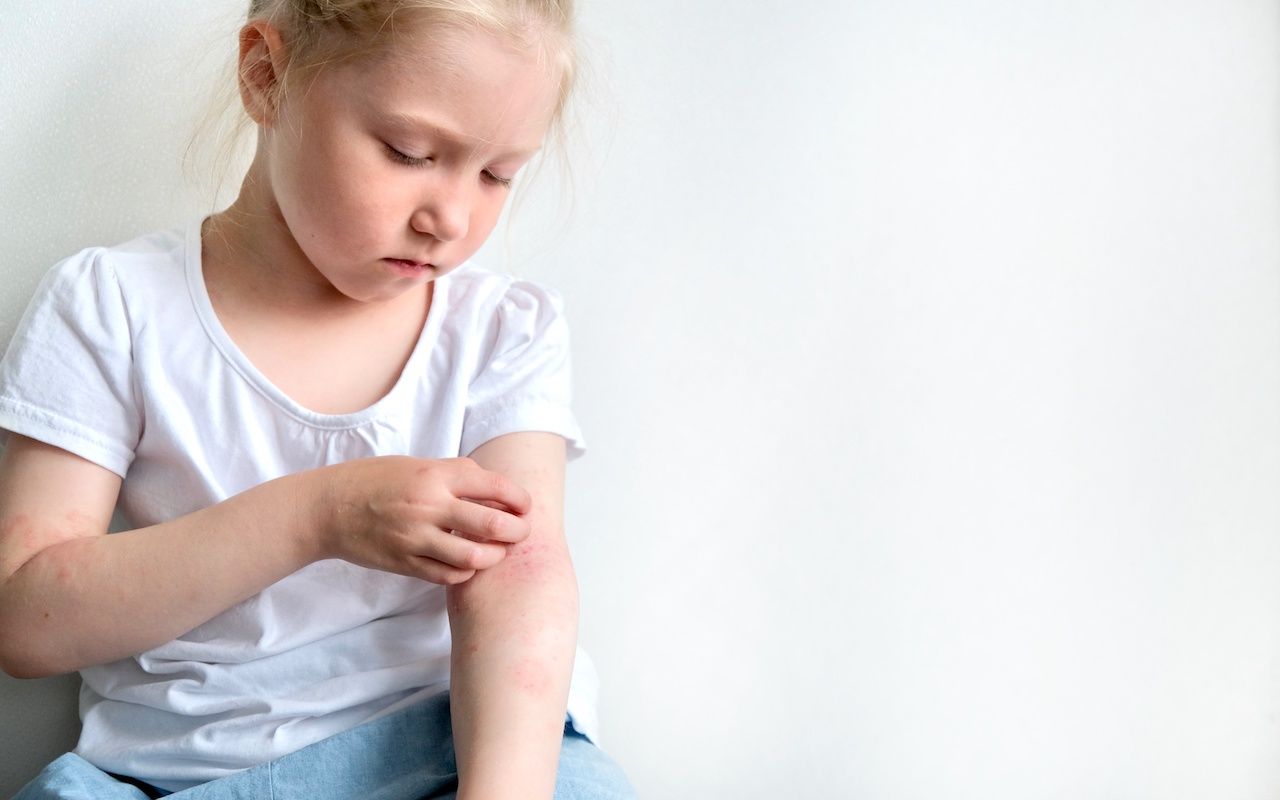 Pediatric Atopic Dermatitis Rapidly Responds To Monoclonal Antibody