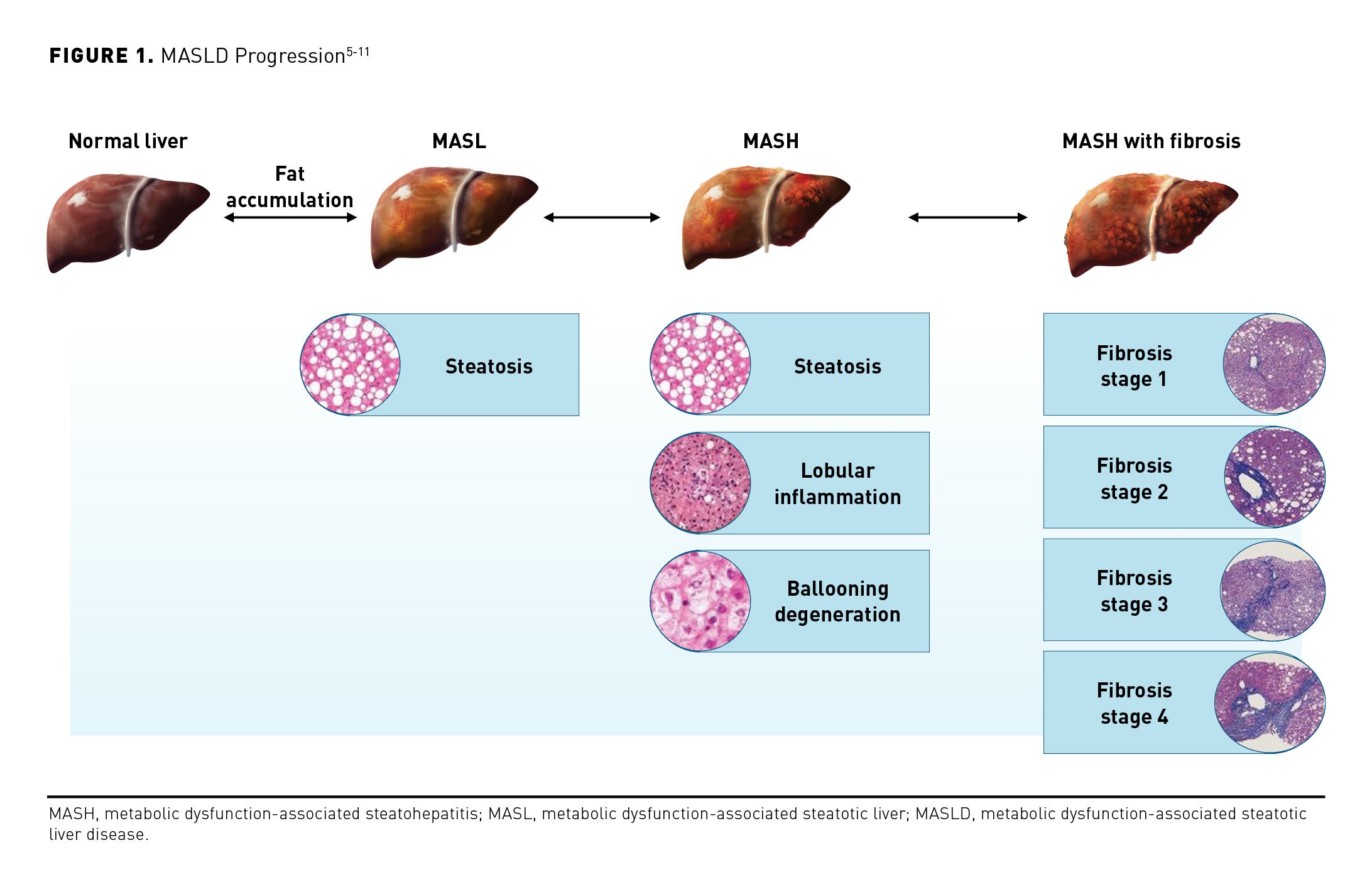 Management Strategies For Metabolic Dysfunction Associated Steatotic