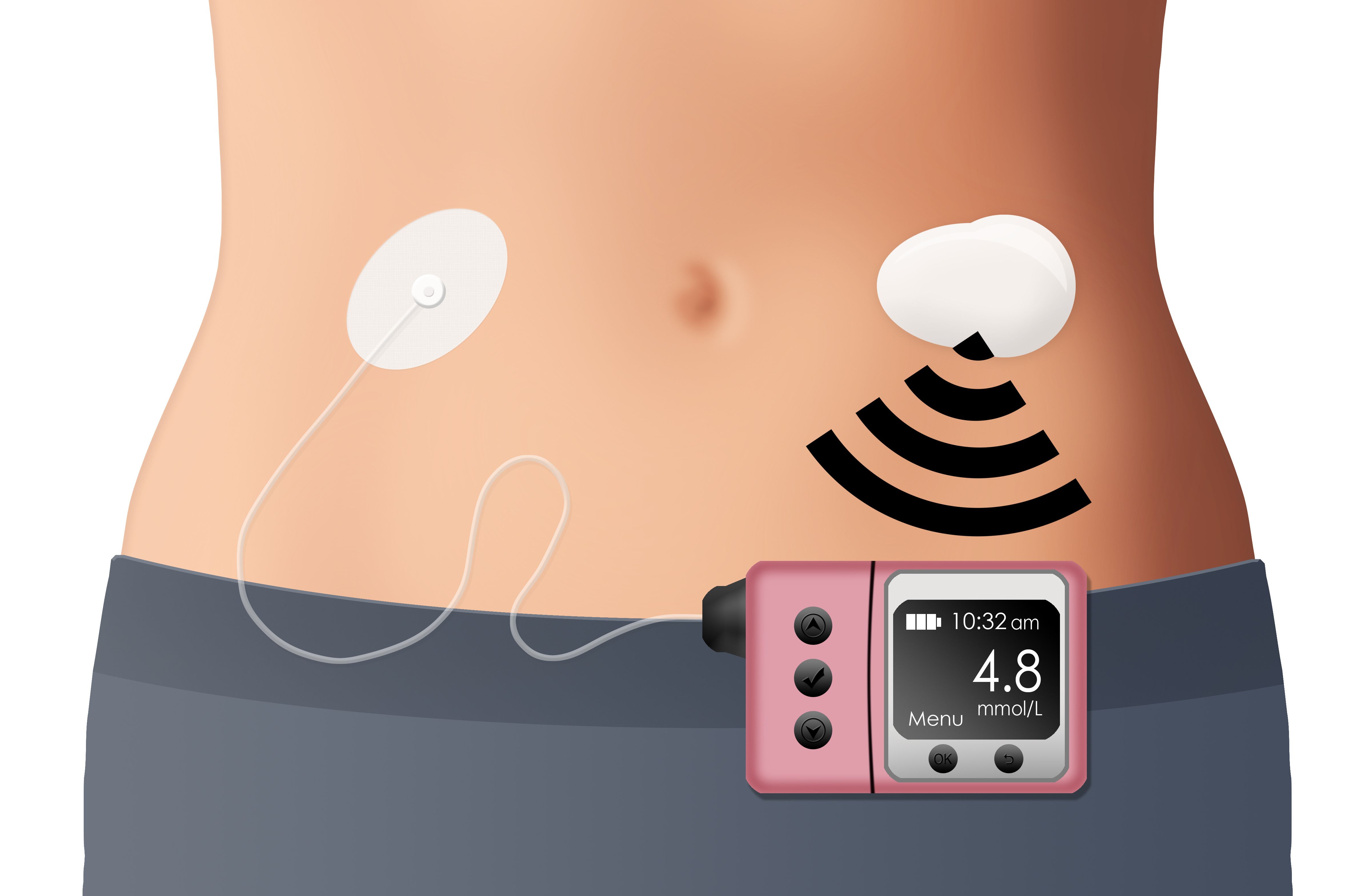 Bionic Pancreas More Effective at Managing T1D Compared With Standard ...