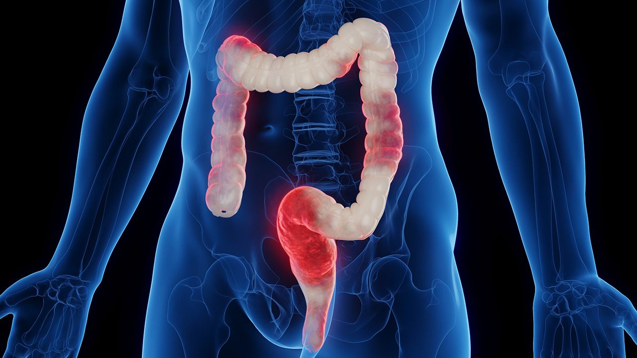 Lilly’s Omvoh Shows Four-Year Disease Clearance in Ulcerative Colitis ...