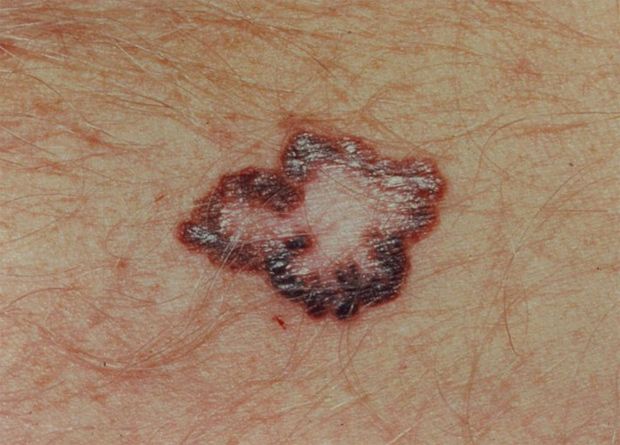Slide Show: Melanoma and Other Skin Cancers | Cancer Network