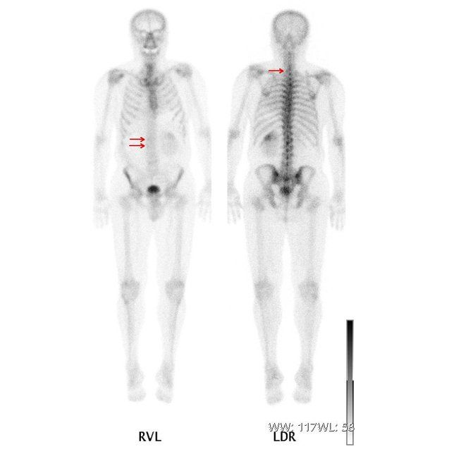 Slide Show: Bone Metastases