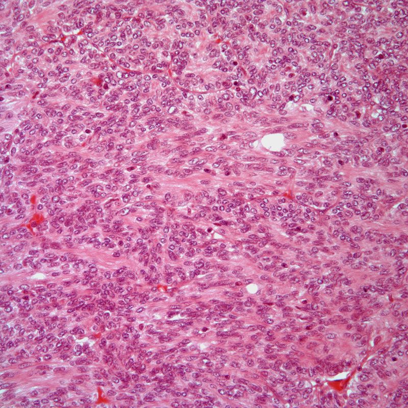 Patient Presents With Anterior Mediastinal Mass | CancerNetwork