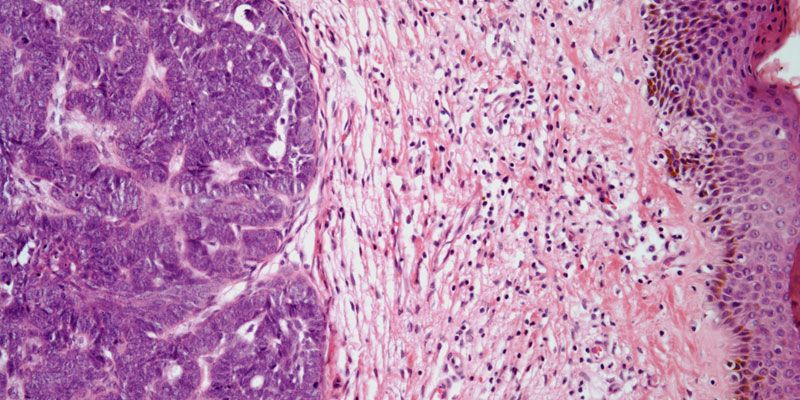 Patient Presents With Dermal Lesion