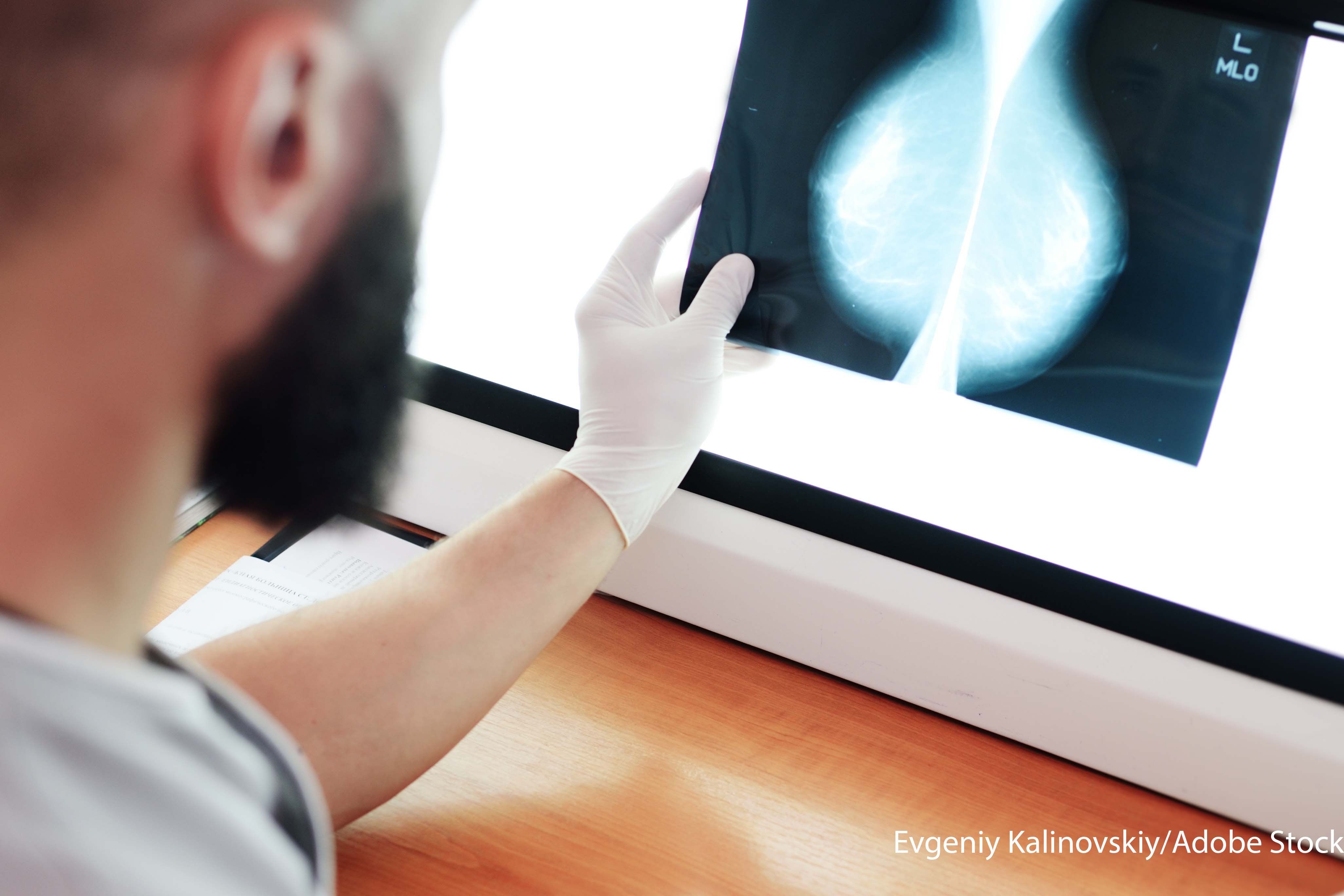 AI and Radiologists Together: Better Breast Cancer Diagnoses?
