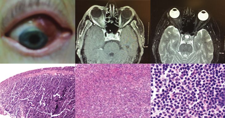 Patient Presents With Eye Redness, Fleshy Overgrowth of the Bulbar ...