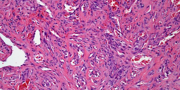 Patient Presents With Buttock Lesion | CancerNetwork