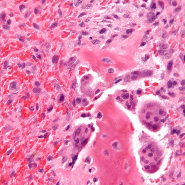 Slide Show: Bone Metastases