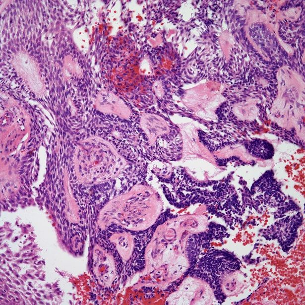 A 48-Year-Old Man With Pain in the Right Maxilla