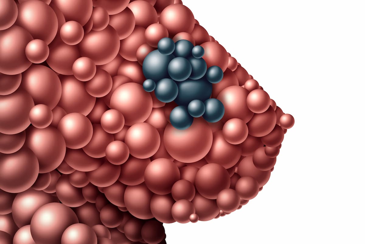 Early Monitoring Of Adjuvant Abemaciclib In High Risk Hrher2 Breast Cancer May Reduce