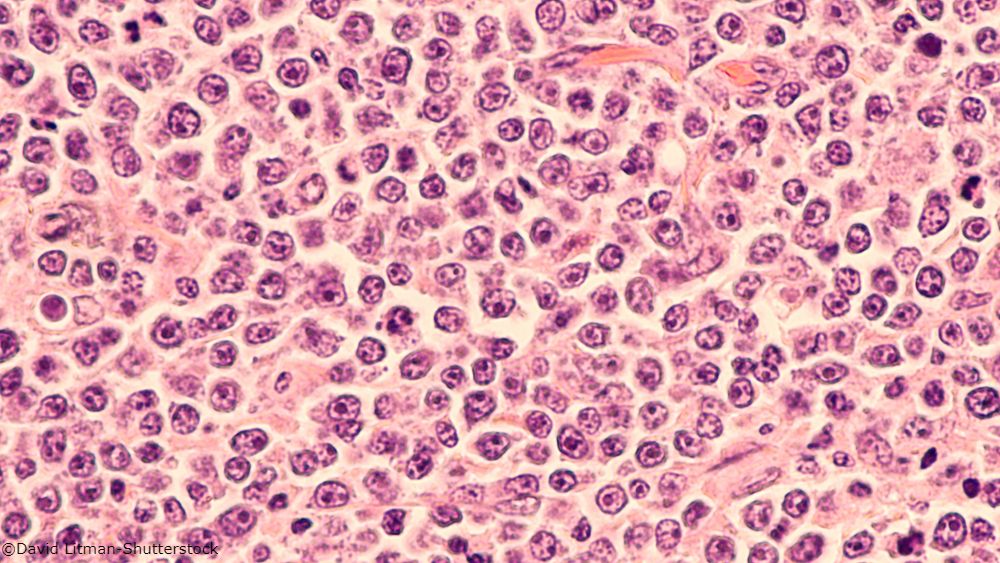 'Game-changing' New Treatment for NHS Lymphoma Patients