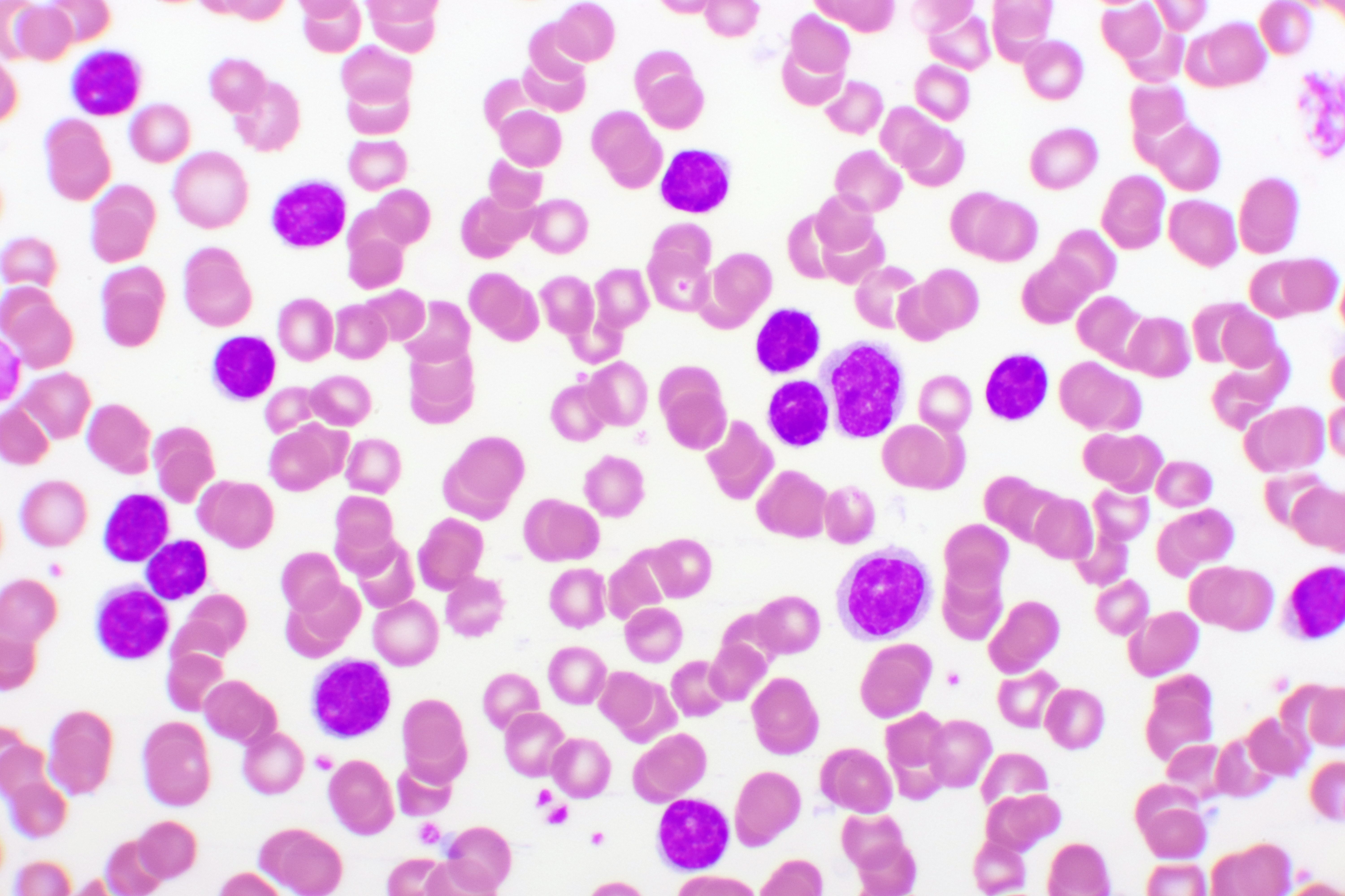 Phase 3 VIALE-A Trial Finds Venetoclax, Azacitidine Combo Safe ...