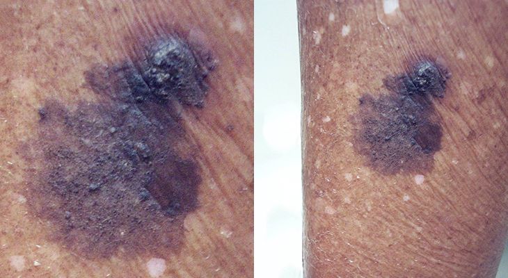 A 67-Year-Old African American Woman Presents With a Lesion on the ...