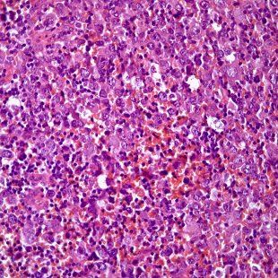 34-Year-Old Man Presents With a Soft Tissue Induration in the Right Thigh