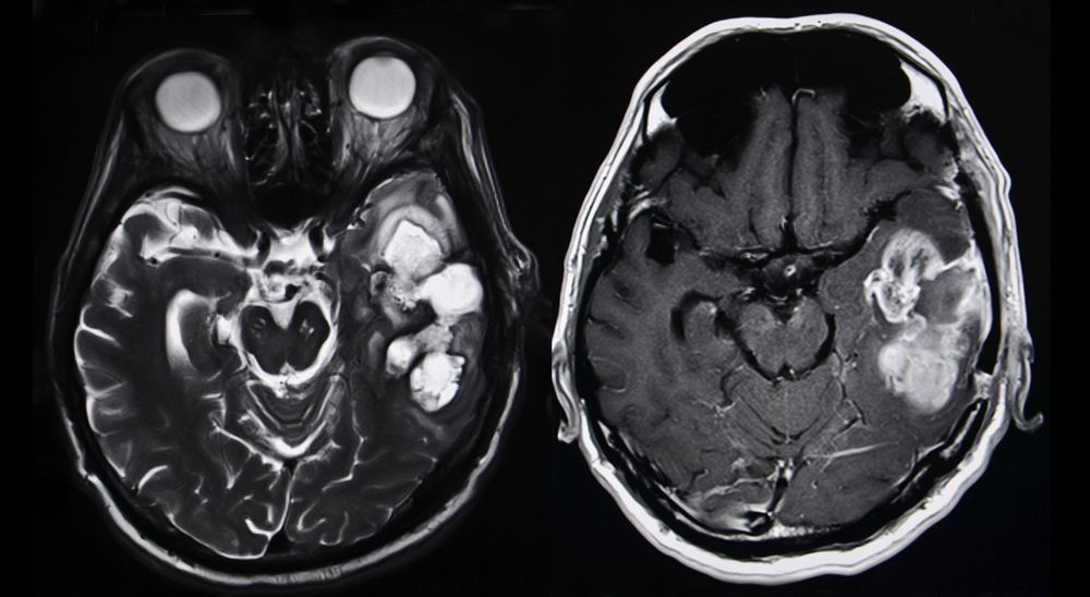 Gene Therapy in Recurrent Glioma Shows Promise in Early Trial