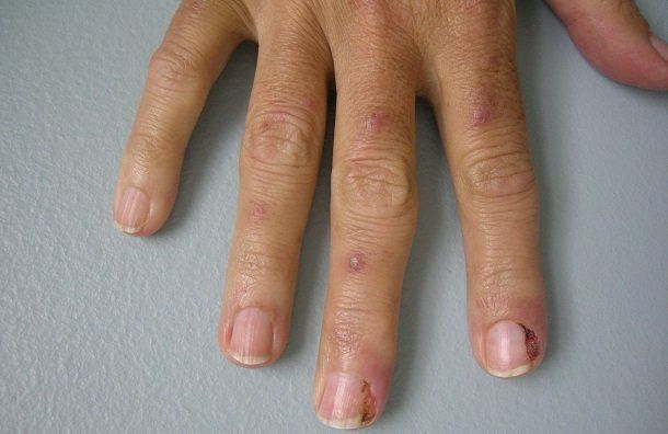 A 75-Year-Old Male Develops Painful Erythema Around His Nails After ...