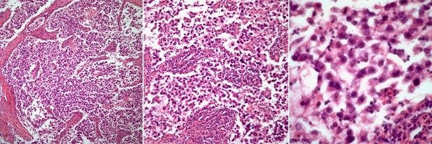 A 30-Year-Old Man Presents With Swelling of the Right Testicle