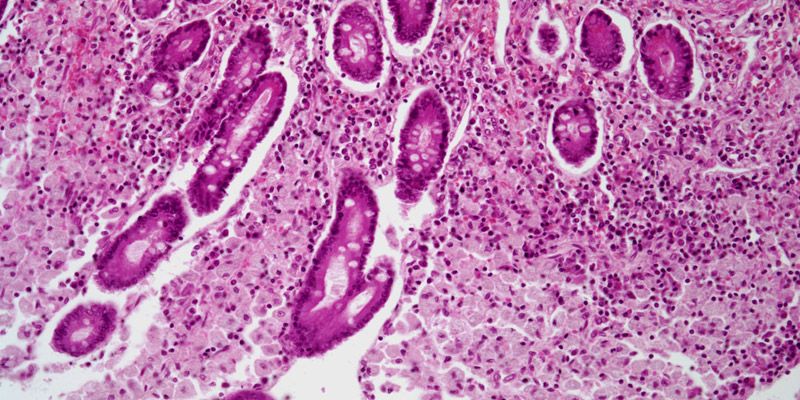 Colon Biopsy From 32-Year-Old Patient
