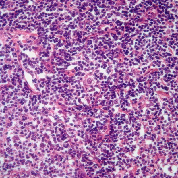 Patient Presents With Enlarged Axillary Lymph Nodes