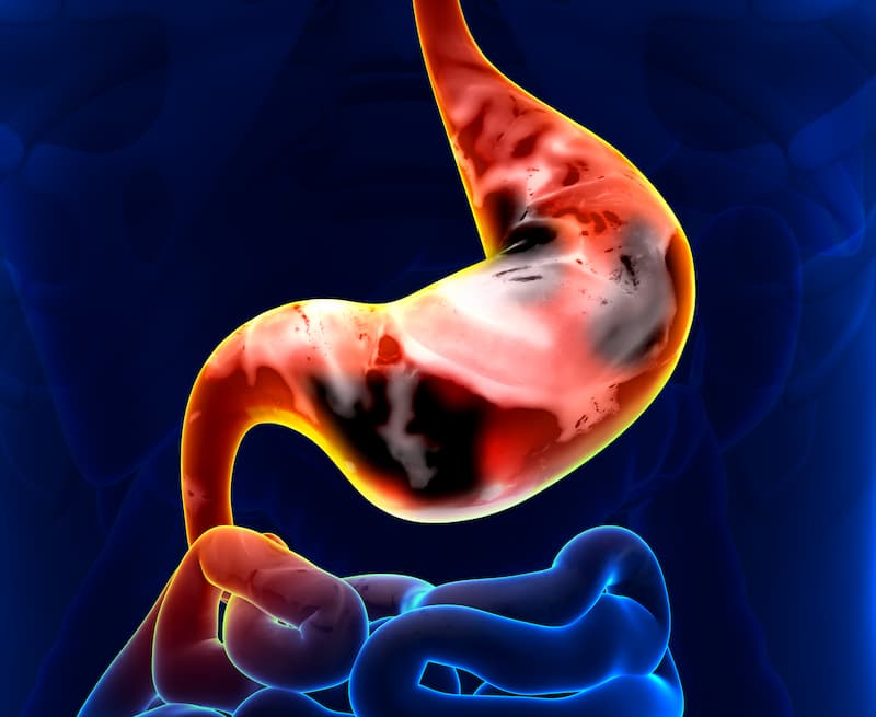 Bemarituzumab Plus mFOLFOX6 Demonstrates Promising Clinical Efficacy in ...