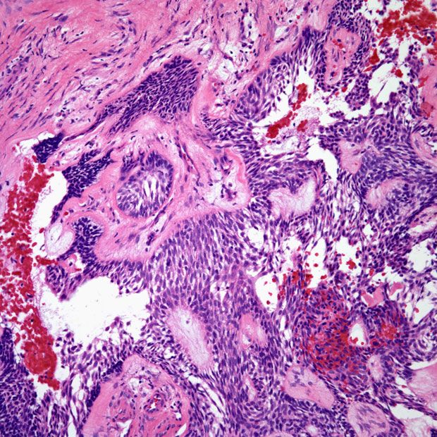 Tumor Discovered in Jaw of 47-Year-Old Patient | CancerNetwork