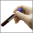 Patient Diagnosed With Clinical Stage T1c Prostate Cancer | CancerNetwork