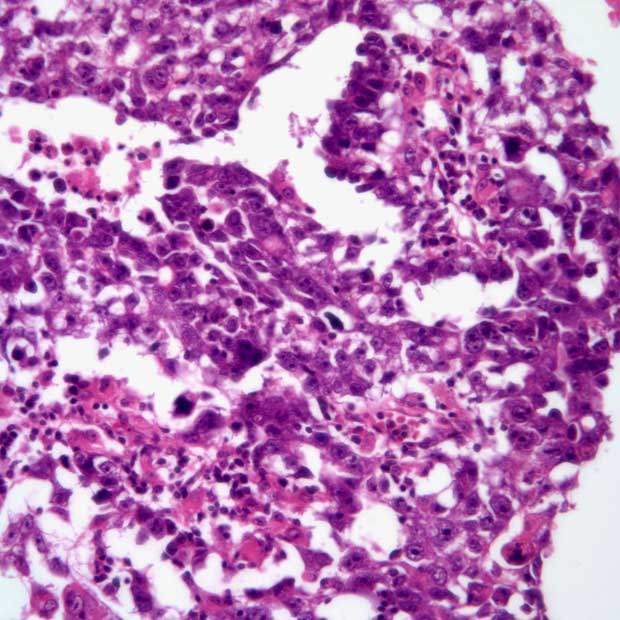 Complete Retroperitoneal Resection Appears Critical Vs RPLND in ...